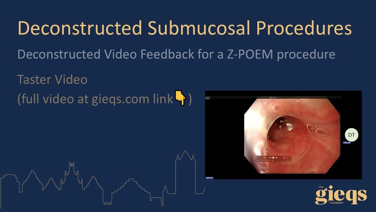 Deconstructed Video Feedback for a Z-POEM procedure (Taster Video ...