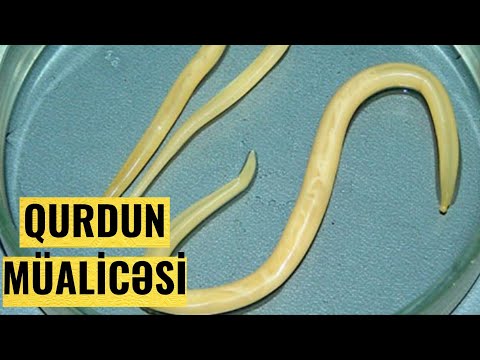 Ağzınızda gələn qoxunun səbəbi bu ola  bilər - Qurdun müalicəsi