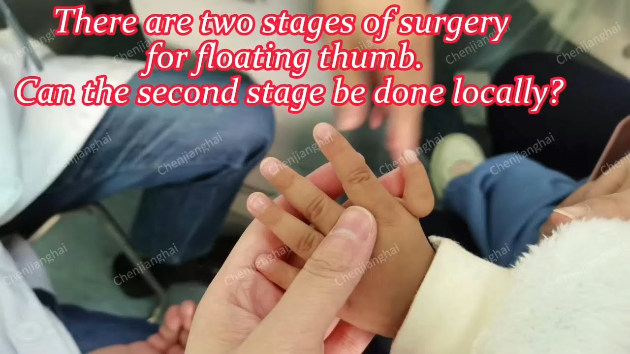 There are two stages of surgery for floating thumb. Can the second ...