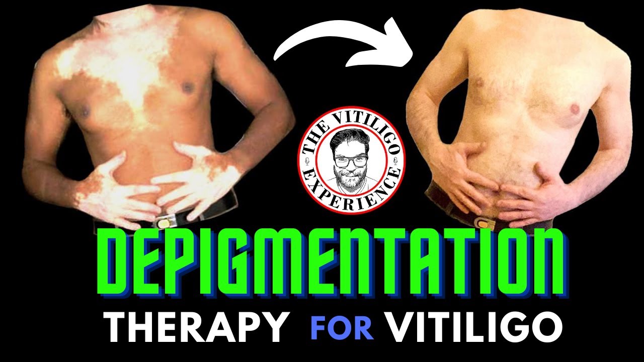 Depigmentation : A Vitiligo treatment which works and is permanent ...
