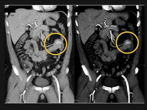 Would An Intestinal Obstruction Show Up On Mri