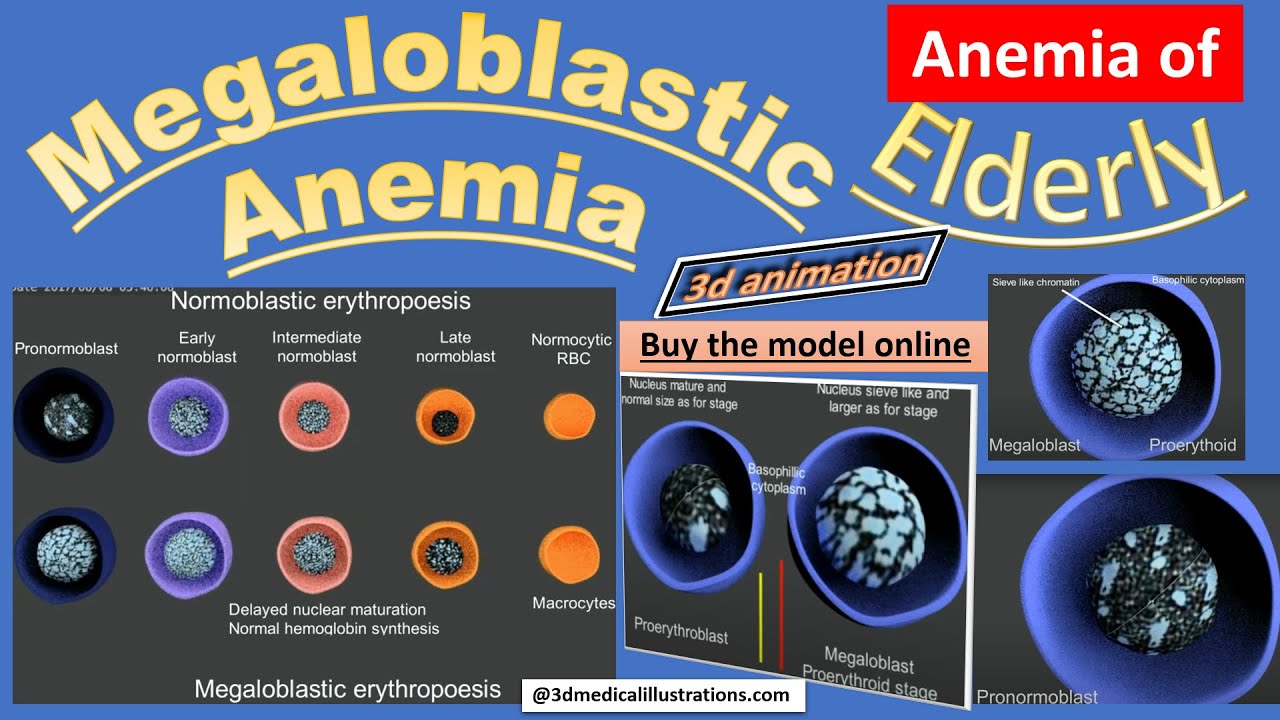 megaloblastic anaemia - megaloblastic anemia - megaloblast morphology I ...