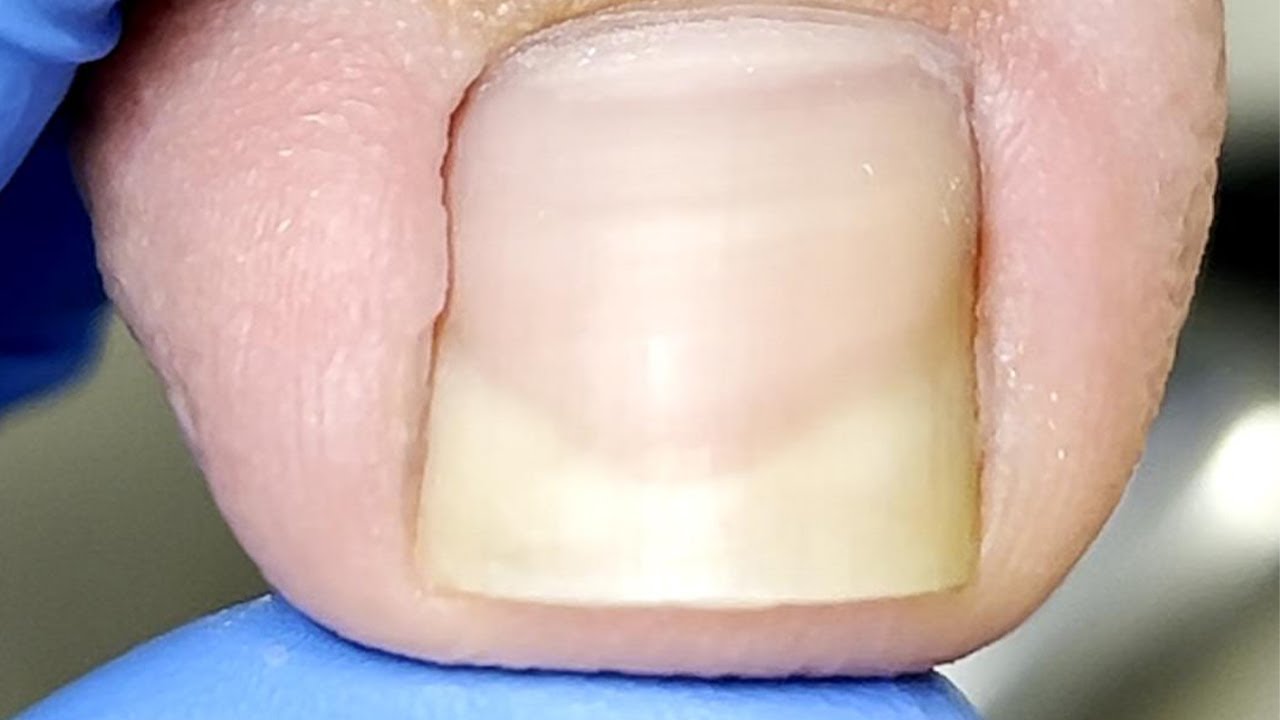 Trim long toenails in 1 minute and heal!【Xue Yidao Pedicure】 - YouTube