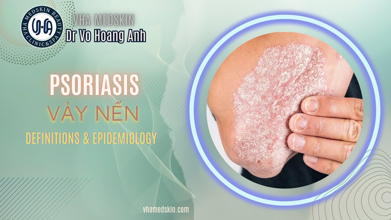 Psoriasis/ Definition, Epidemiology & Genetics/ Vảy nến| Dịch tễ - BS ...