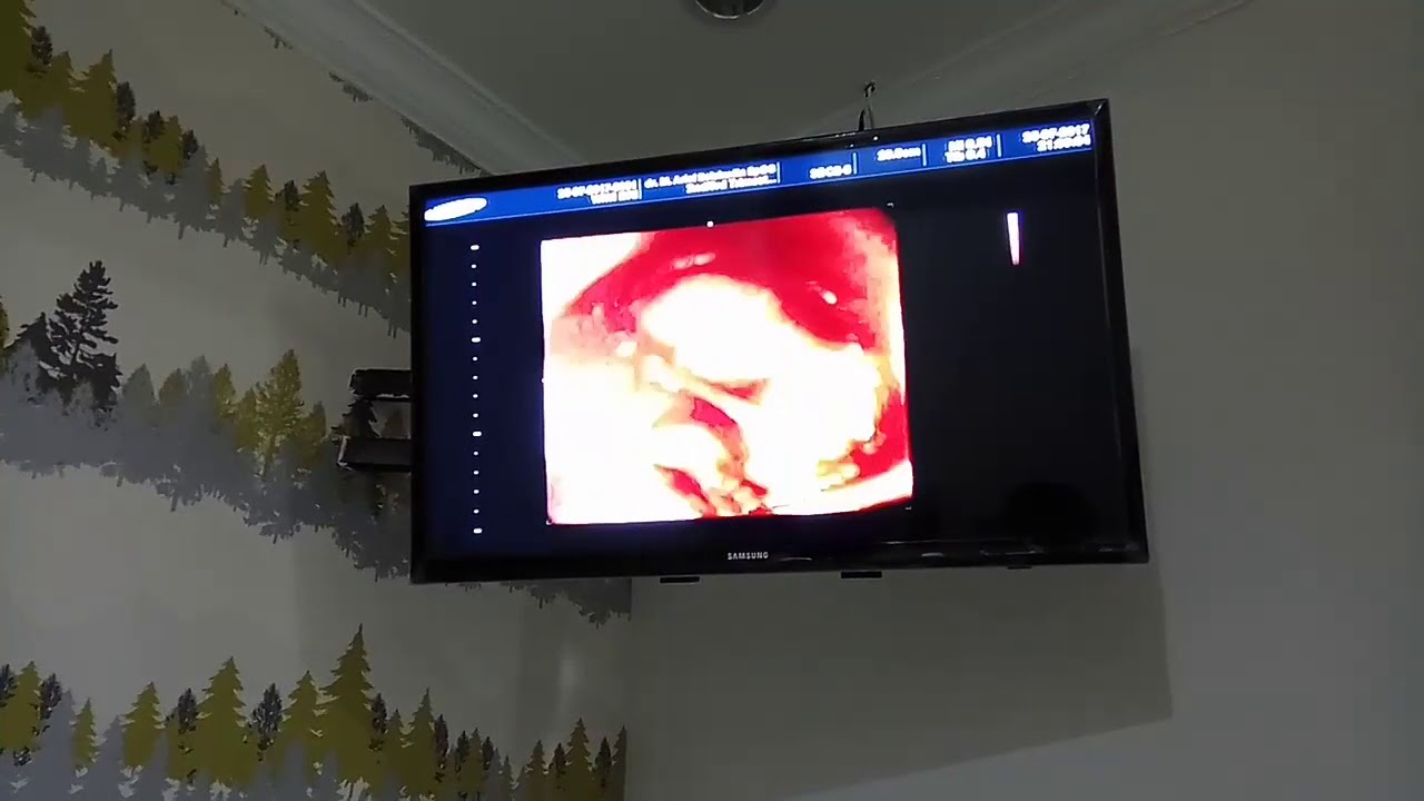 USG Bayi 21 Week - YouTube