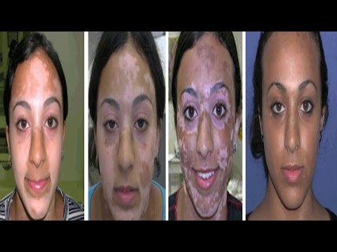 सफेद दाग तुरंत ख़त्म करने का रामबाण घरेलु नुस्खा | Safed Daag Ka Ilaj ...
