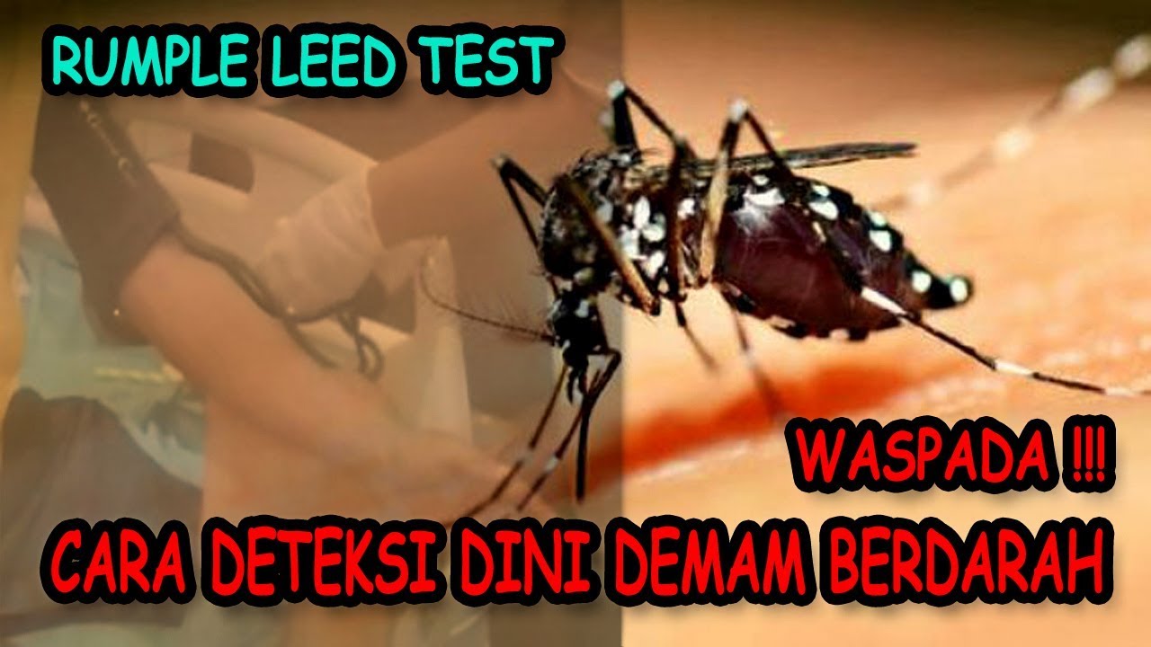 Rumple Leed Test - Cara Deteksi Dini DBD (Demam Berdarah) ~~ WASPADA ...
