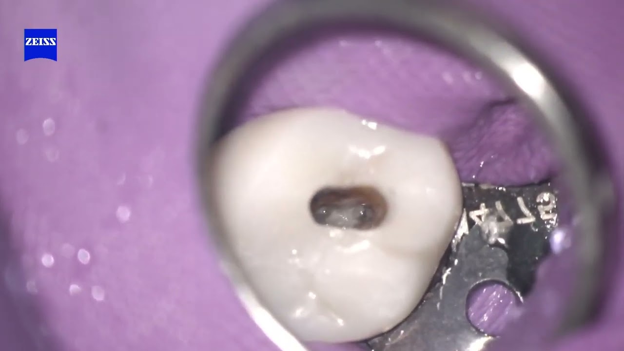 Maxillary first molar endodontic treatment steps- access preparation ...