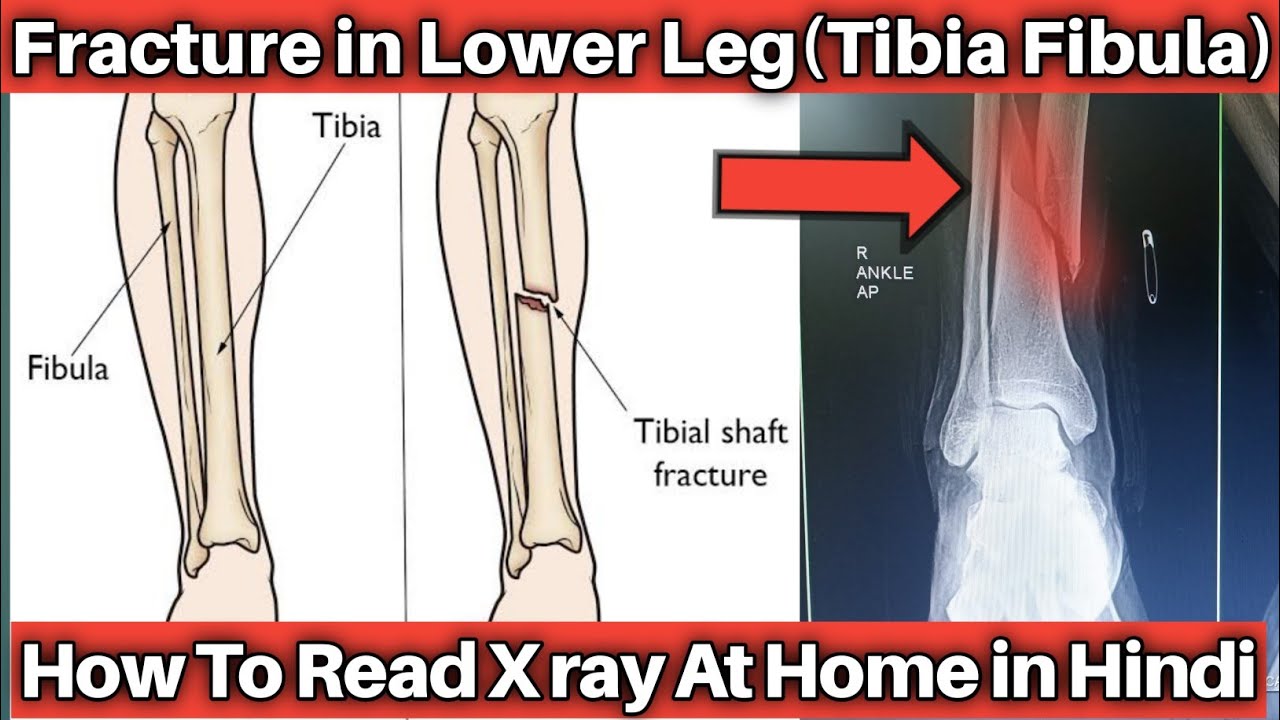 X Ray Tibia Fibula | How to read lower leg x ray | fracture in lower ...