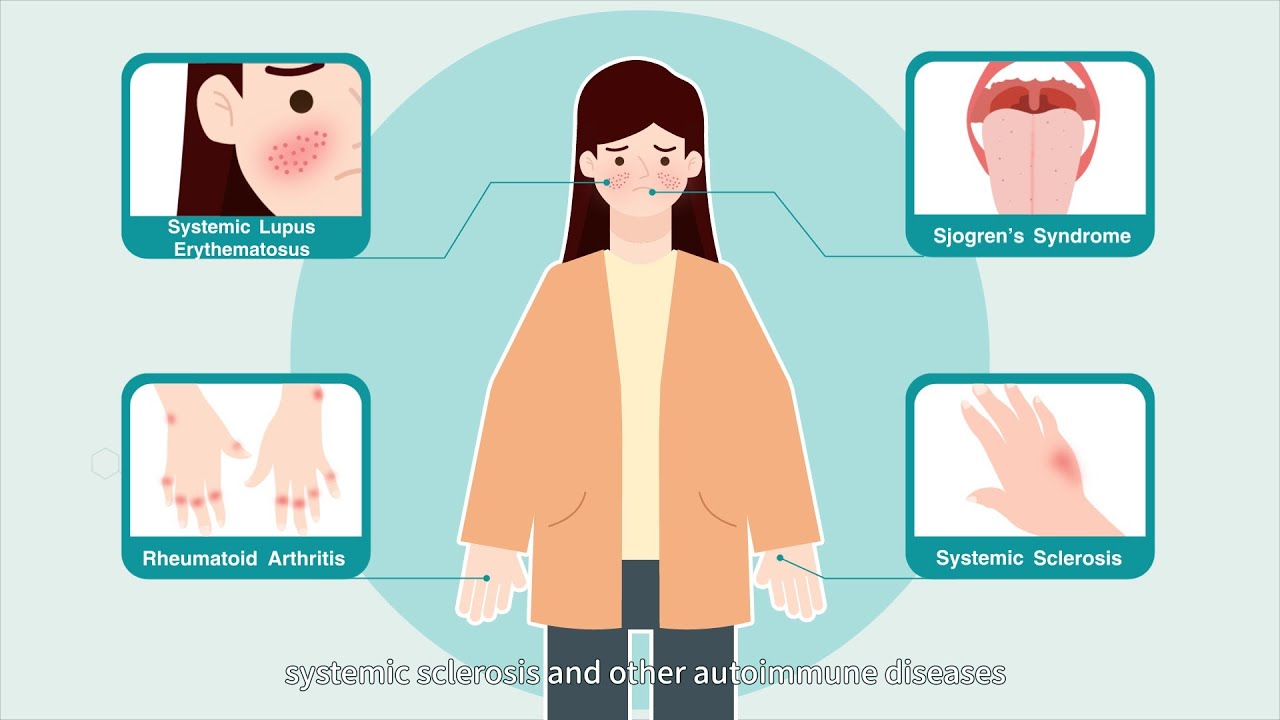 APS and the diagnosis - YouTube