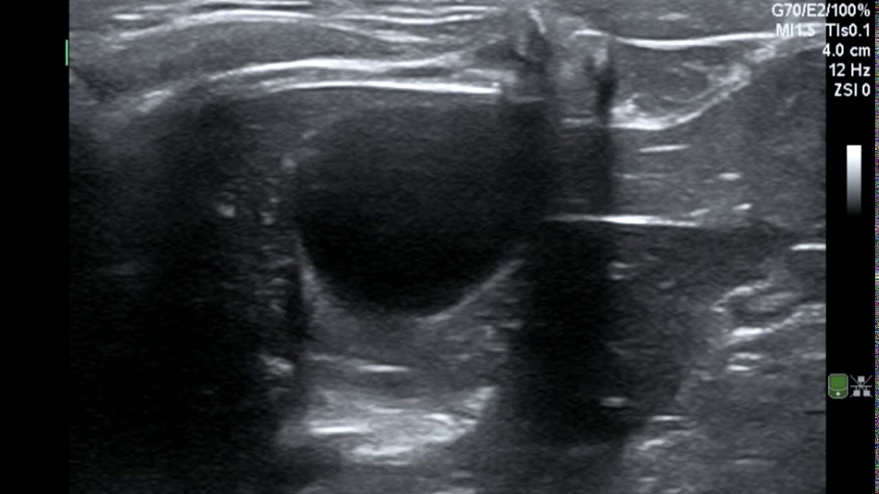 Triaditis felina - YouTube