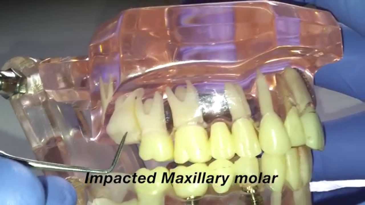 All in one Dental Patient Education Model - YouTube