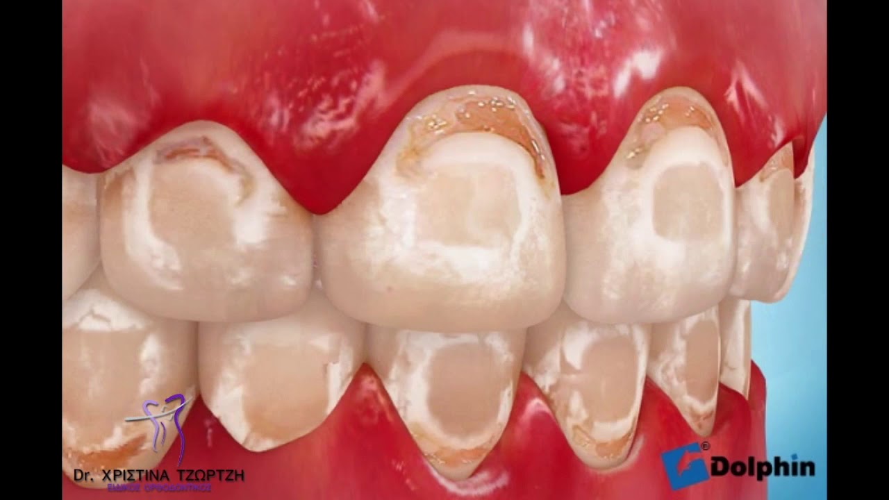 Decalcification Orthodontics - Dr. Tzortzi - YouTube