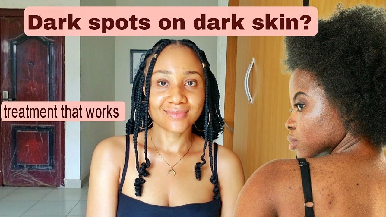 HOW TO GET RID OF DARK SPOTS ON DARK SKIN.hyperpigmentation treatment ...