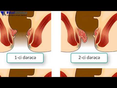 Babasilin lazerlə götürülməsi