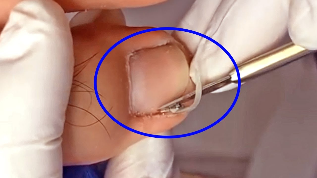 How To Cut A Nail How To Remove Thick Nails Why Are My Thick Nail how-to-cut-a-nail-how-to-remove-thick-nails-why-are-my-thick-nail