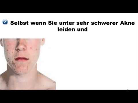 Akne Auf Dem Rücken - YouTube