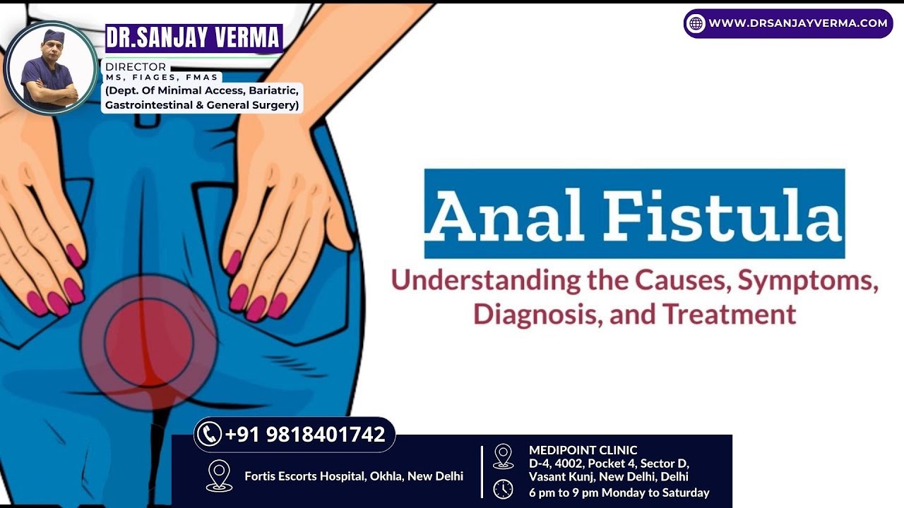 Fistula Explained: Symptoms, Causes, and the Best Treatment Options ...