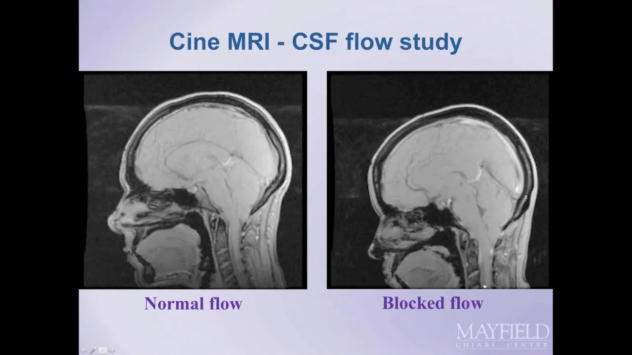 2017 XXIX ASAP Conference Video Poster: Chiari Diagnosis & Treatment ...