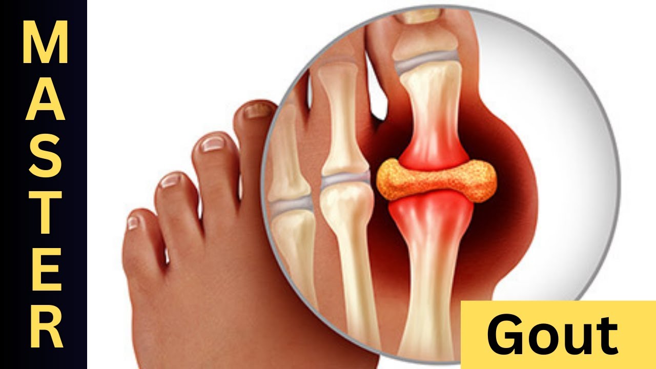 Ultimate Gout Mastery: Beat Pain And Swelling With Uric Acid Control ...