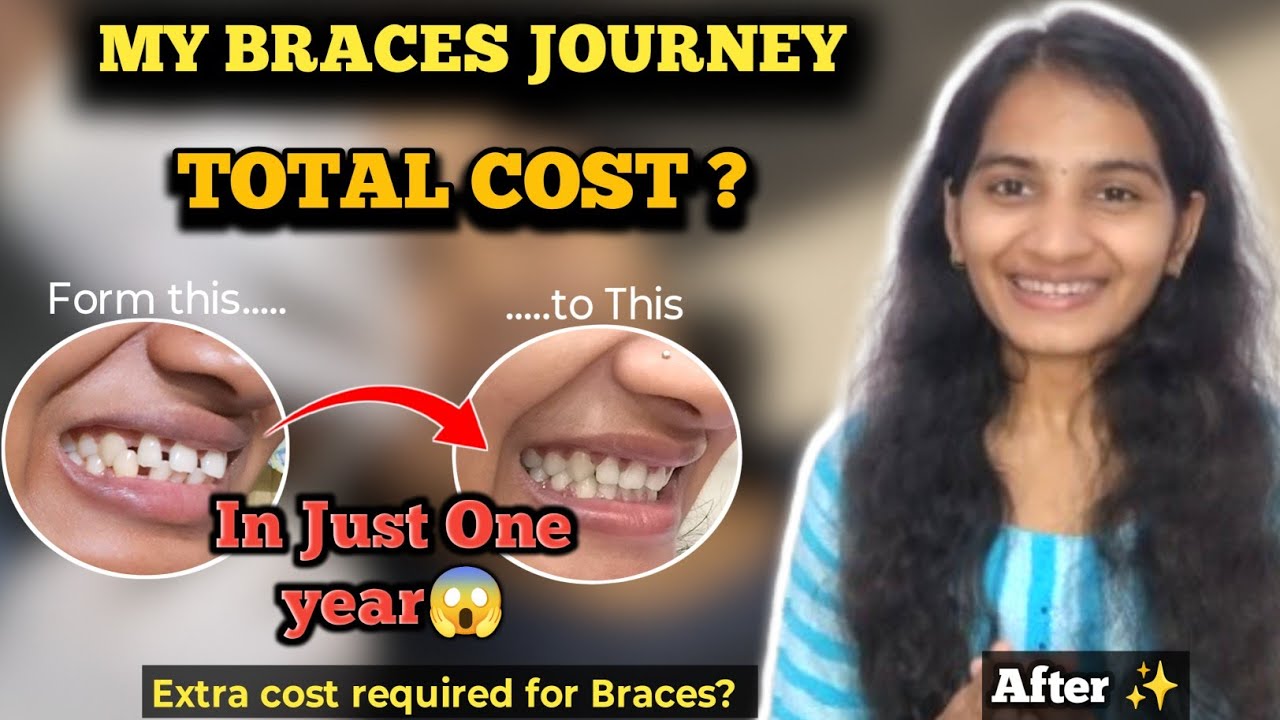 Total Cost of My Braces Treatment?🦷😱 - YouTube