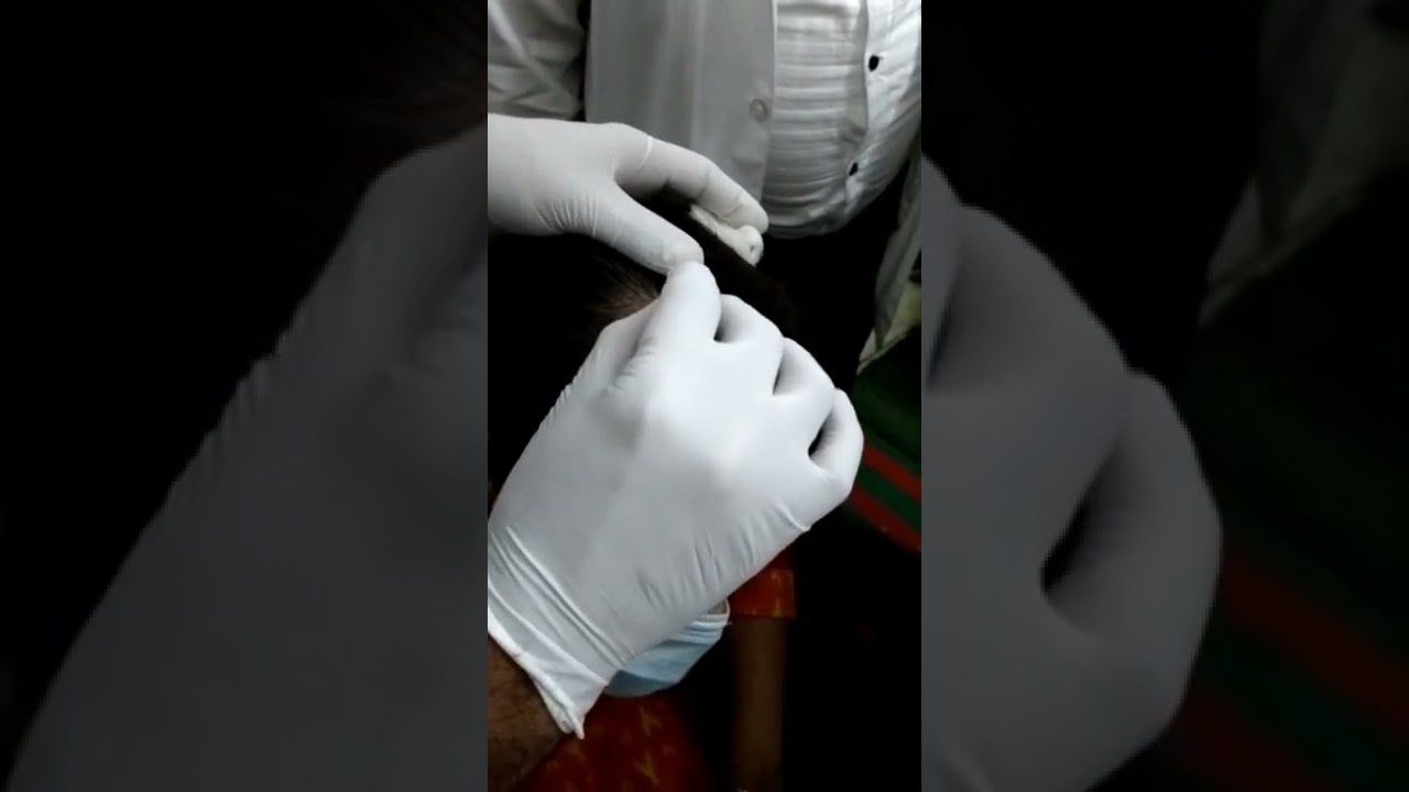 Prachanna Karma Ayurveda Panchakarma Procedure By Dr Febin Paul Jose MD Ayu - YouTube