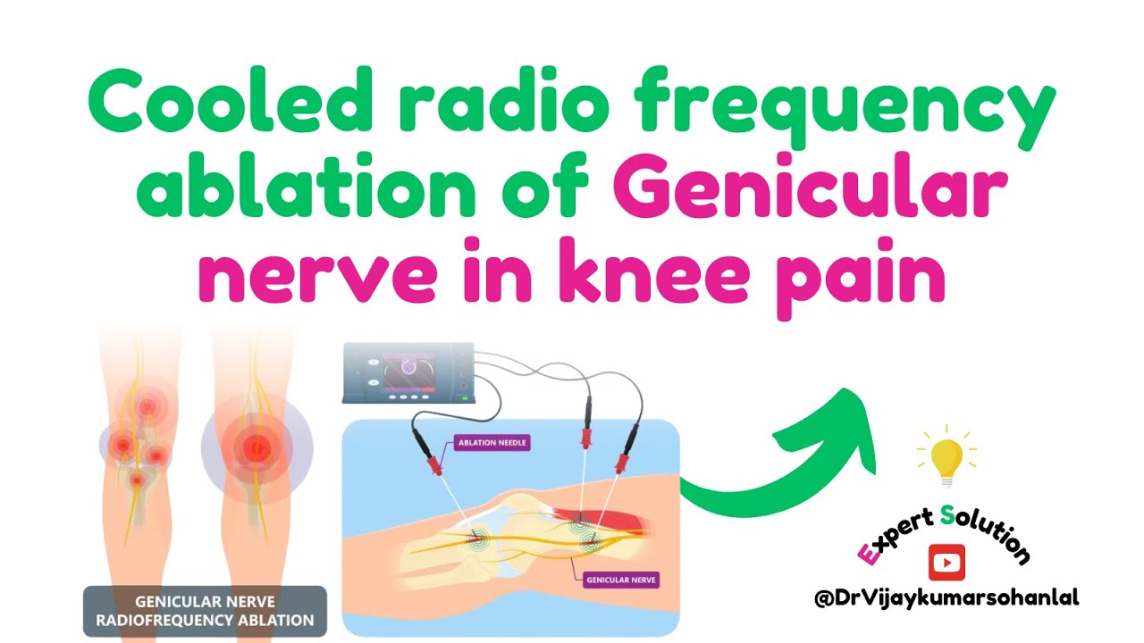 Cooled radio frequency ablation of Genicular nerve in knee pain - YouTube