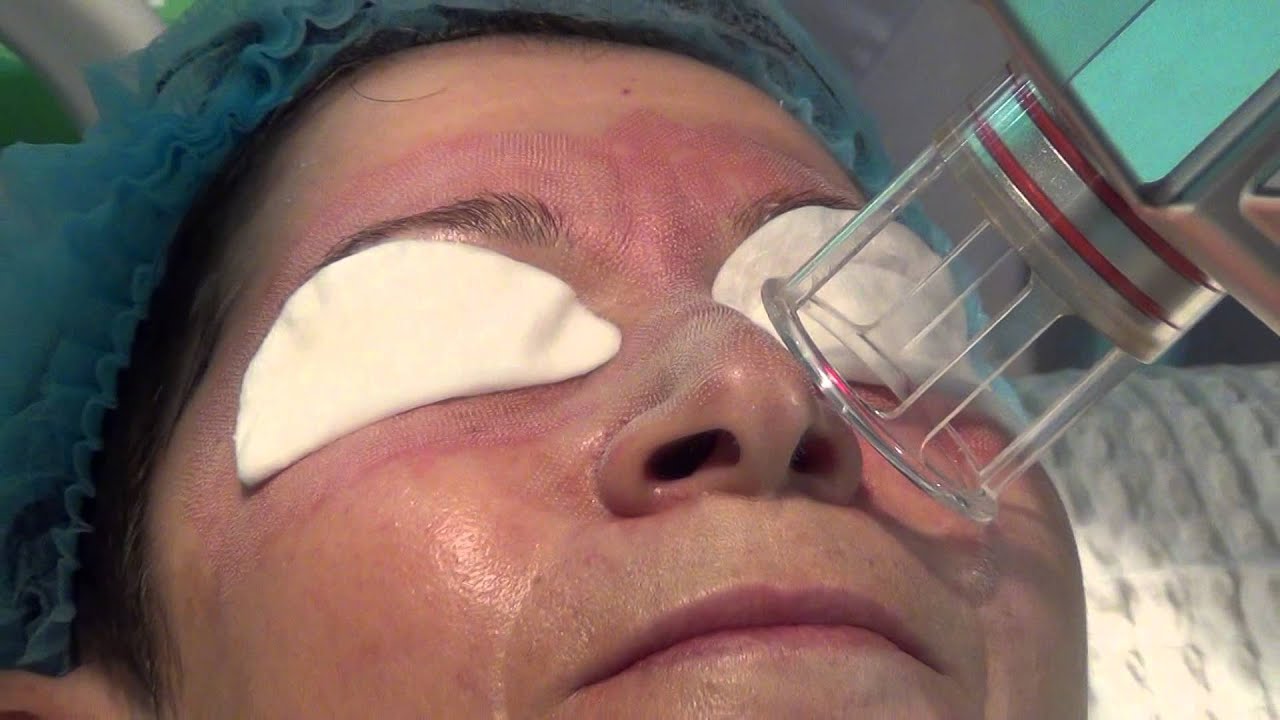 Демонстрация на бумаге и на пациентах Labite - YouTube