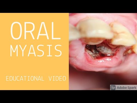 #oralmyisis #maggots വായയിൽ പുഴു | Worms in Mouth | Causes and ...