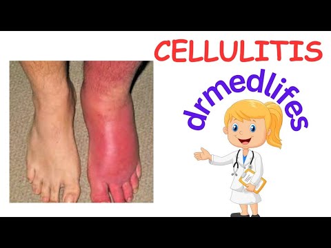 cellulitis - causes ,clinical features , investigation, treatment ...