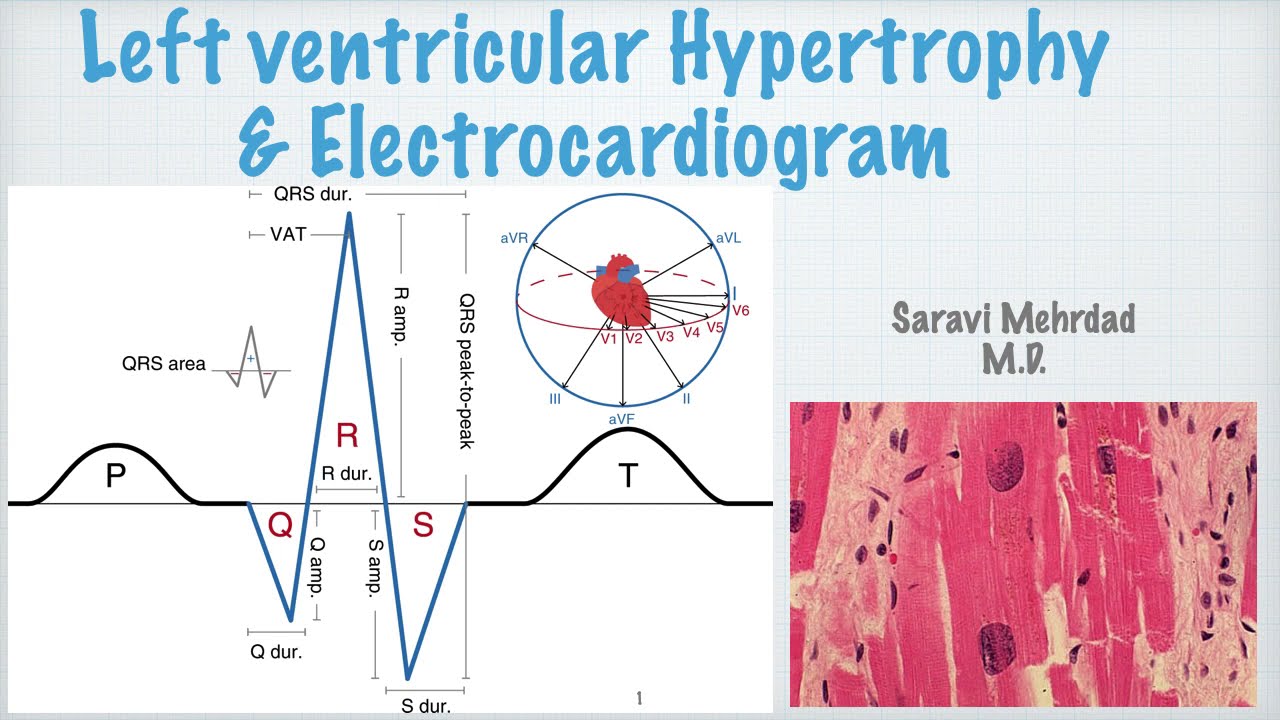 Left Ventricular Hypertrophy ECG - YouTube