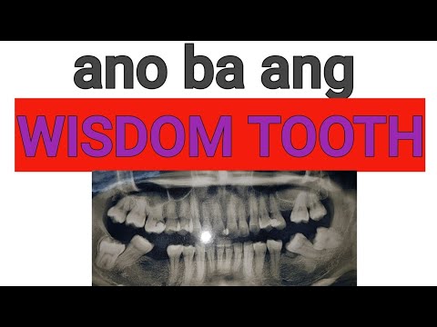 Ano ba ang wisdom tooth? - YouTube