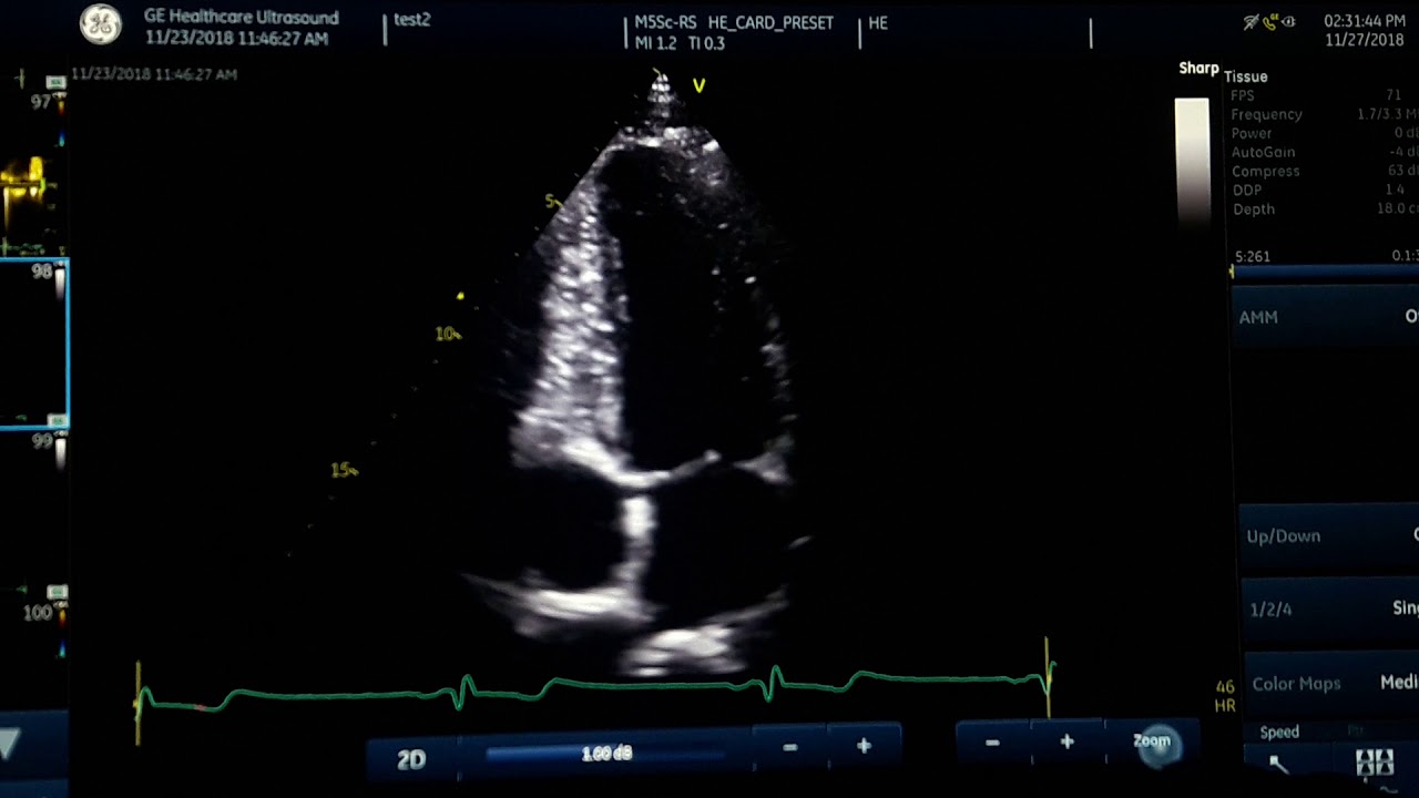 Apical 2 chamber (A2C ) view - YouTube