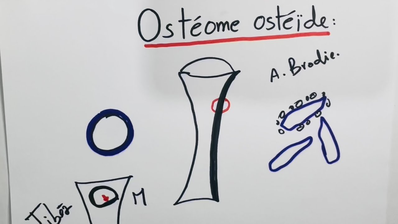 Orthopédie Tumeurs osseuses ( Ostéome ostéoïde ) - YouTube