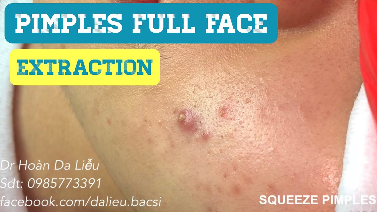Chích mụn ẩn mụn mủ|Squeeze super big pimples, whiteheads, blackhead ...