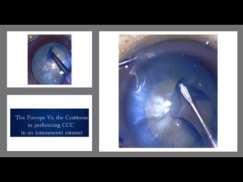The Cystitome Vs. the Utrata Forceps performing the capsulorrhexis in ...