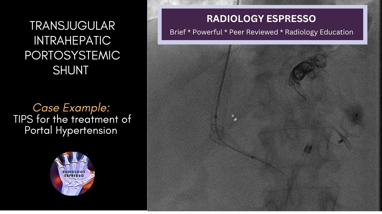 TRANSJUGULAR INTRAHEPATIC PORTOSYSTEMIC SHUNT: Case Example - TIPS ...