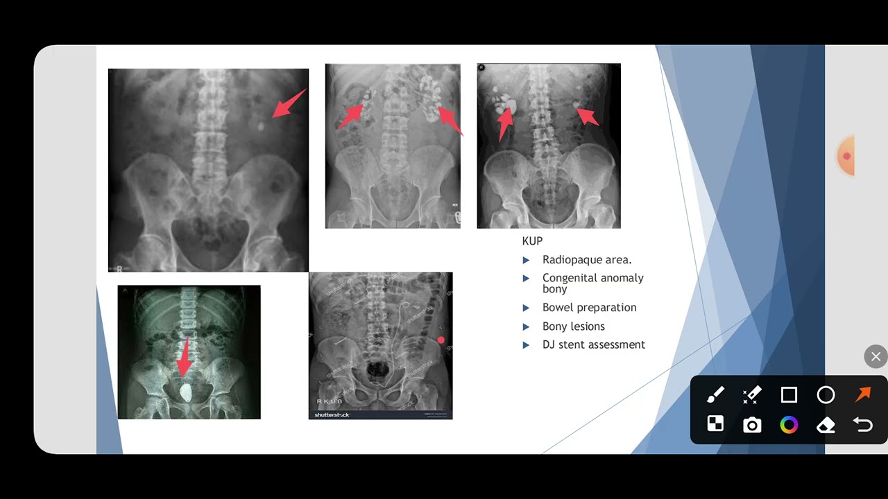 Radiology rotation - Imaging of urinary system - YouTube