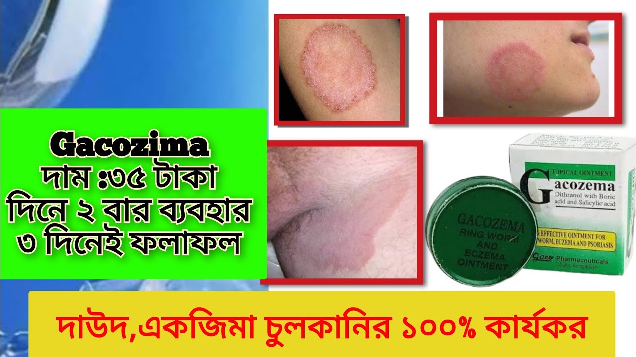 Gacozima Cream দাউদ, চুলকানি ও সোরিয়াসিসের কার্যকর মলম | ব্যবহার ও ...