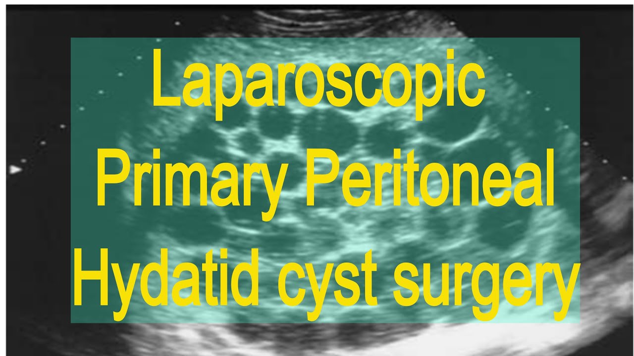 Laparoscopic hydatid cyst surgery | Hydatid cyst surgery| Intra peritoneal hydatid cyst | - YouTube