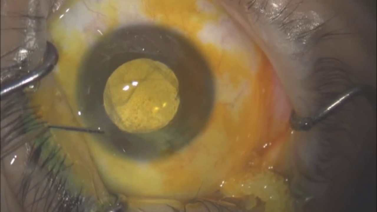 Secondary IOL implantation in the Sulcus - YouTube