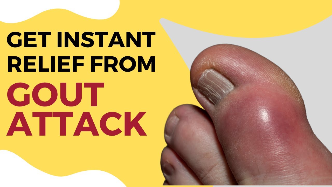 Get Instant Relief From Gout Attack | Homeopathy Treatment - YouTube