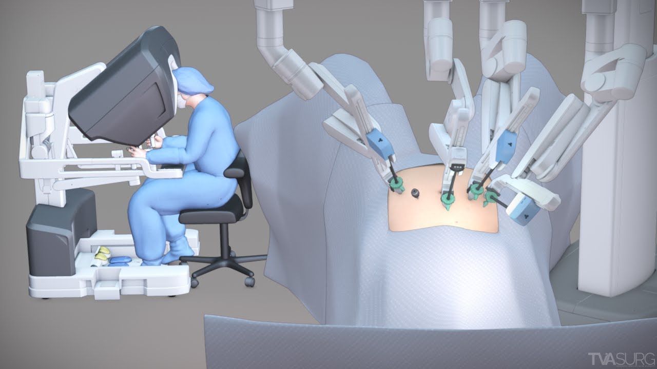 Robotic hysterectomy for high BMI patients | TVASurg - YouTube