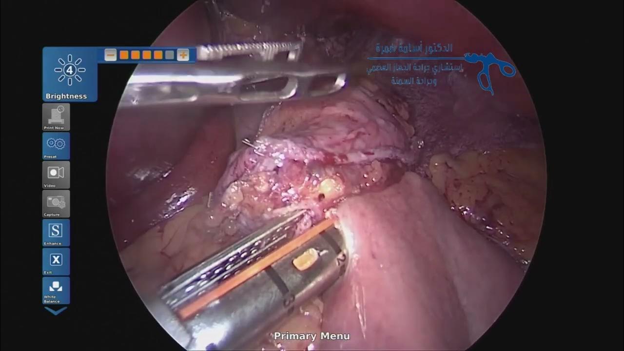 Lap. Revision ( from sleeve to banded rny gastric bypass with hiatal hernia repair) - YouTube