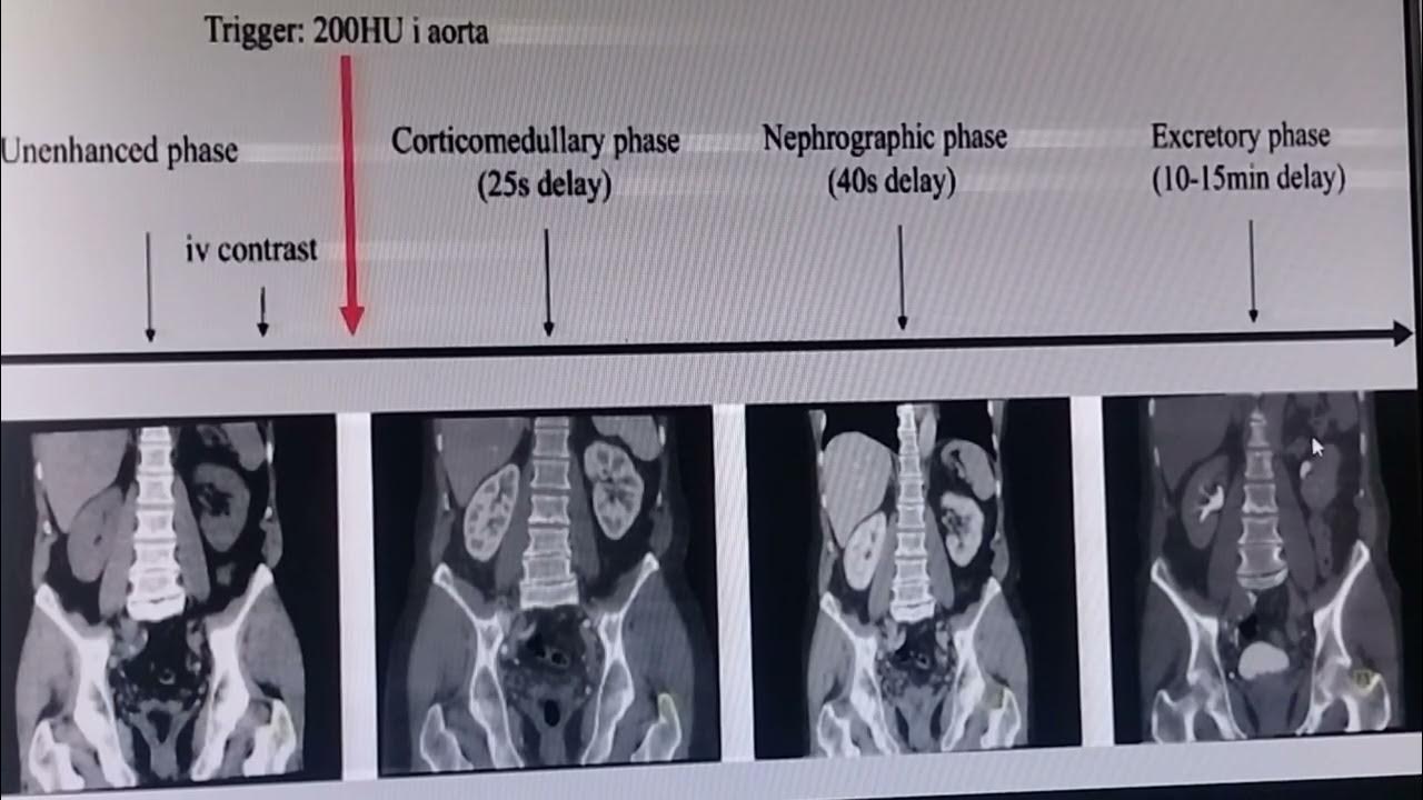 CT SCAN INTERVIEW WITH NCCT KUB CECT KUB UROGRAPHY - YouTube