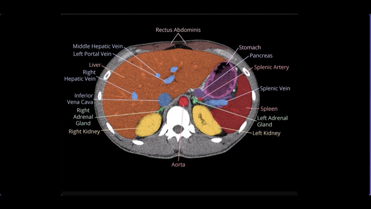 Normal Abdomen anatomy on a CT Scan Simplified: Real CT Images ...
