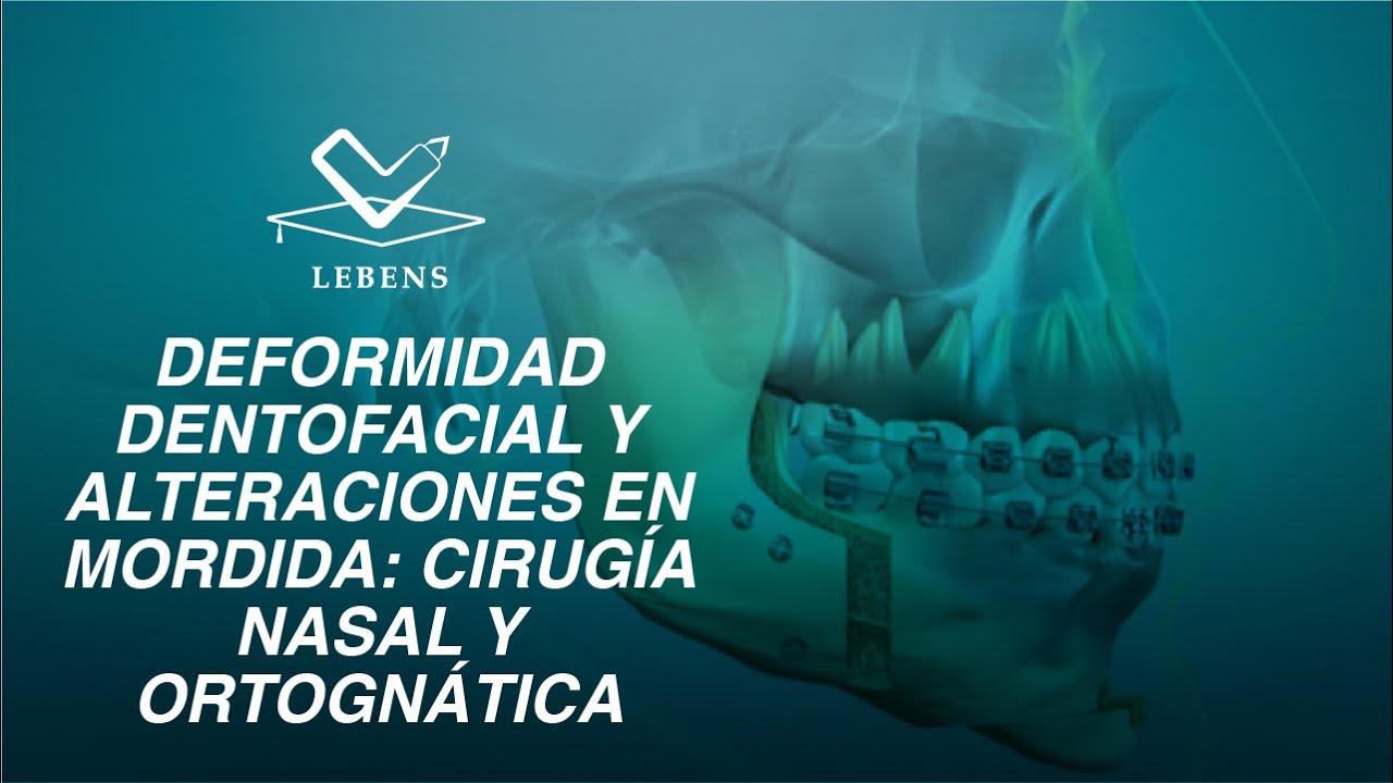 DEFORMIDAD DENTOFACIAL Y ALTERACIONES EN MORDIDA: CIRUGÍA NASAL Y ...