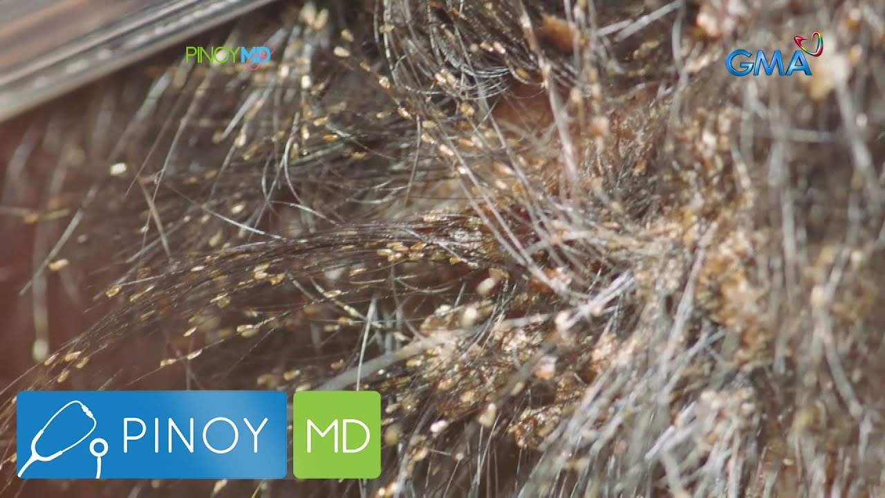 Pinoy MD: Paano maiiwasan ang pagkakaroon ng kuto? - YouTube