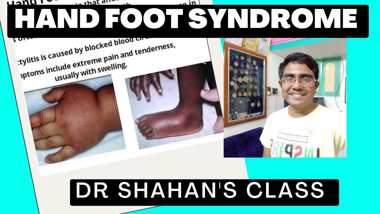 Hand Foot Syndrome | Dr Shahan's Class - YouTube