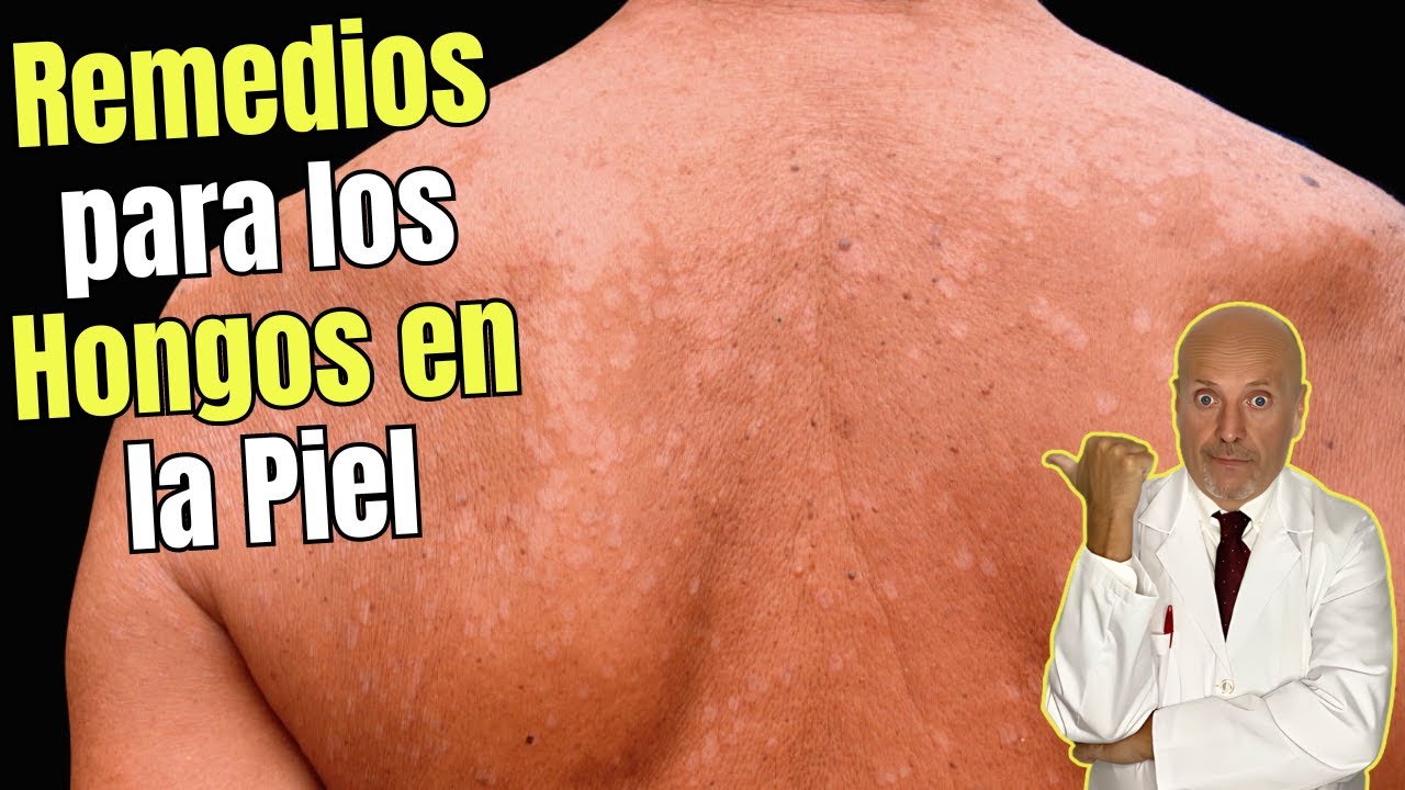 💝 REMEDIOS CASEROS PARA LOS HONGOS EN LA PIEL 💝 - YouTube